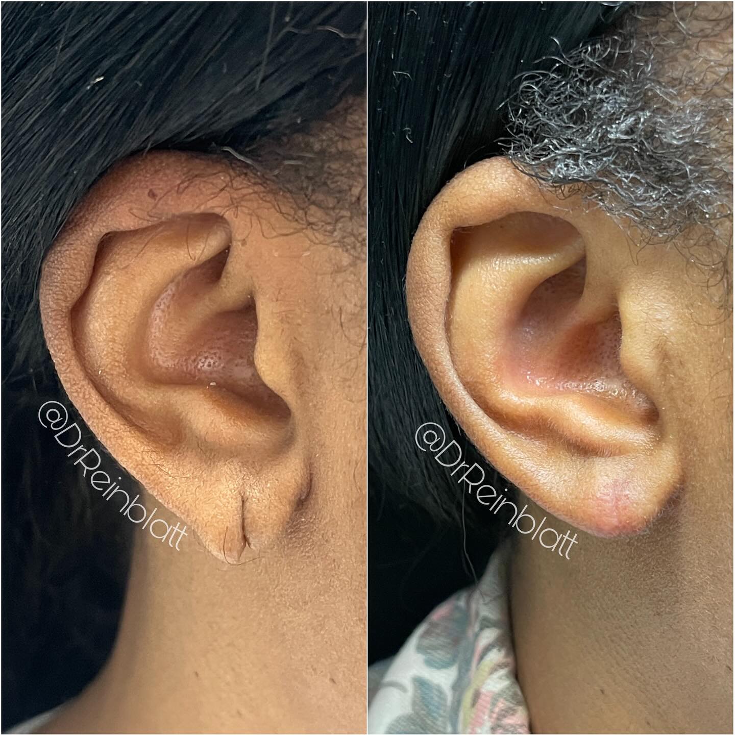 Ear Lobe Repair In Westchester NY White Plains